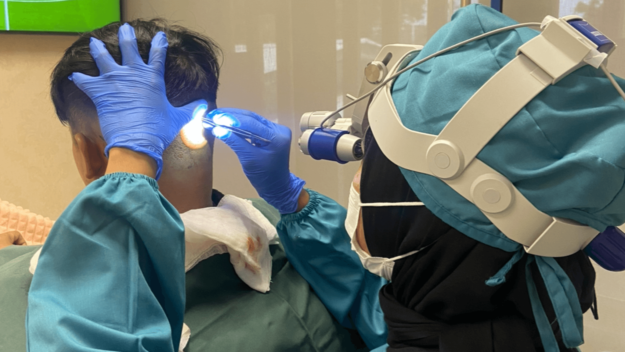 Unshaved Hair Transplant - Tanam Rambut Indonesia