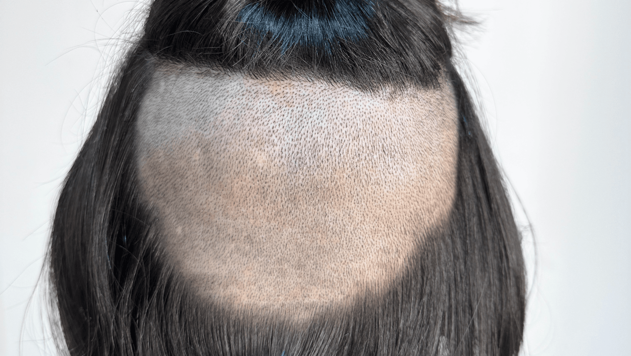 Female Hair Transplant - Tanam Rambut Indonesia